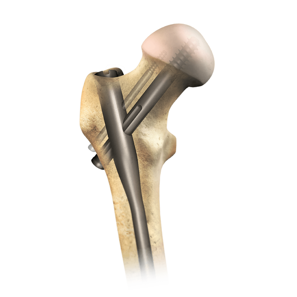 Zimmer Biomet - Bryden pi